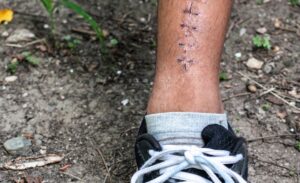 Can You Exercise With Stitches? A Complete Guide - SportCoaching