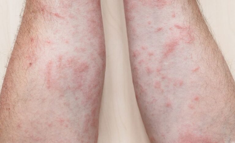 Exercise-Induced Vasculitis: Symptoms & Treatment Options